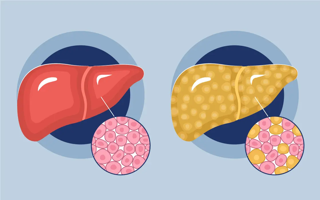 Guía de la Enfermedad del hígado graso no alcohólico (EHGNA)